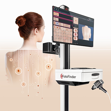 Цялостна дерматоскопия на тяло Fotofinder